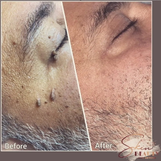What to Expect During and After Skin Tag Removal Treatment in Oakville ...